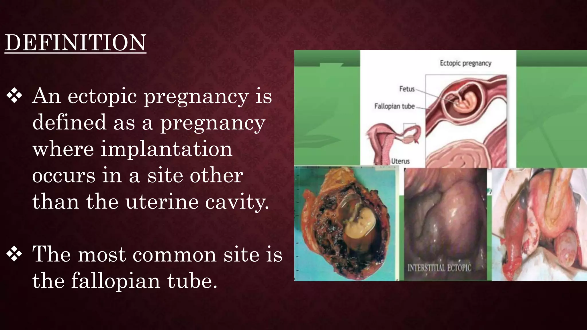ECTOPIC PREGNANCY | PPTX | Pregnancy | Reproductive Health