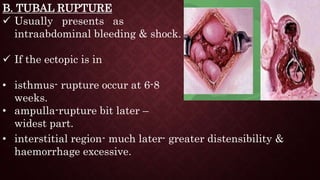 ECTOPIC PREGNANCY | PPTX | Pregnancy | Reproductive Health