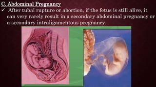 ECTOPIC PREGNANCY | PPTX | Pregnancy | Reproductive Health