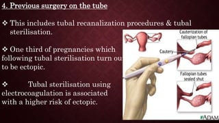 ECTOPIC PREGNANCY | PPTX | Pregnancy | Reproductive Health