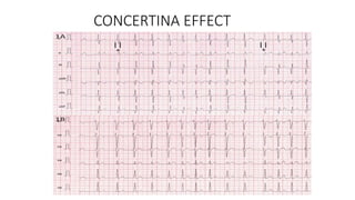 WPW_SYNDROME(PRE-EXCITATION_SYNDROME).pptx