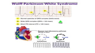 WPW_SYNDROME(PRE-EXCITATION_SYNDROME).pptx