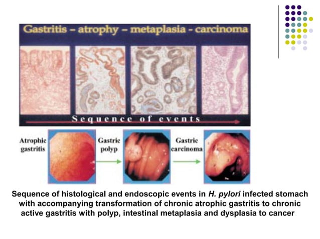 H. pylori | PPT | Digestive Disorders | Diseases and Conditions