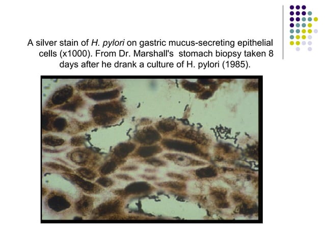 H. pylori | PPT | Digestive Disorders | Diseases and Conditions