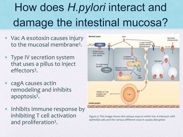 How Helicobacter Pylori can cause gastric ulcerations and how this can ...