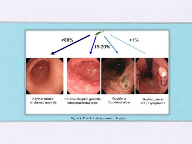 How Helicobacter Pylori can cause gastric ulcerations and how this ca…