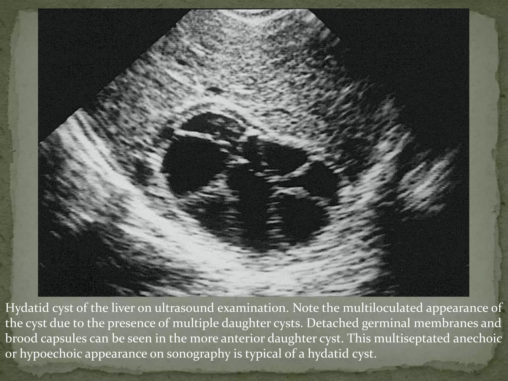Hydatid cyst disaese | PPT