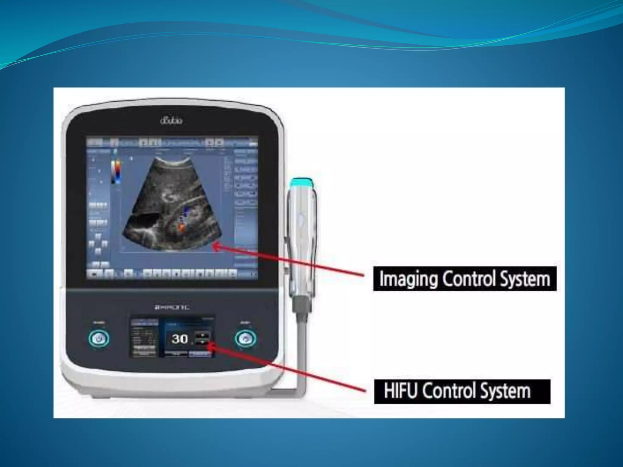 HIFU Technique of Prostate Cancer | PPTX