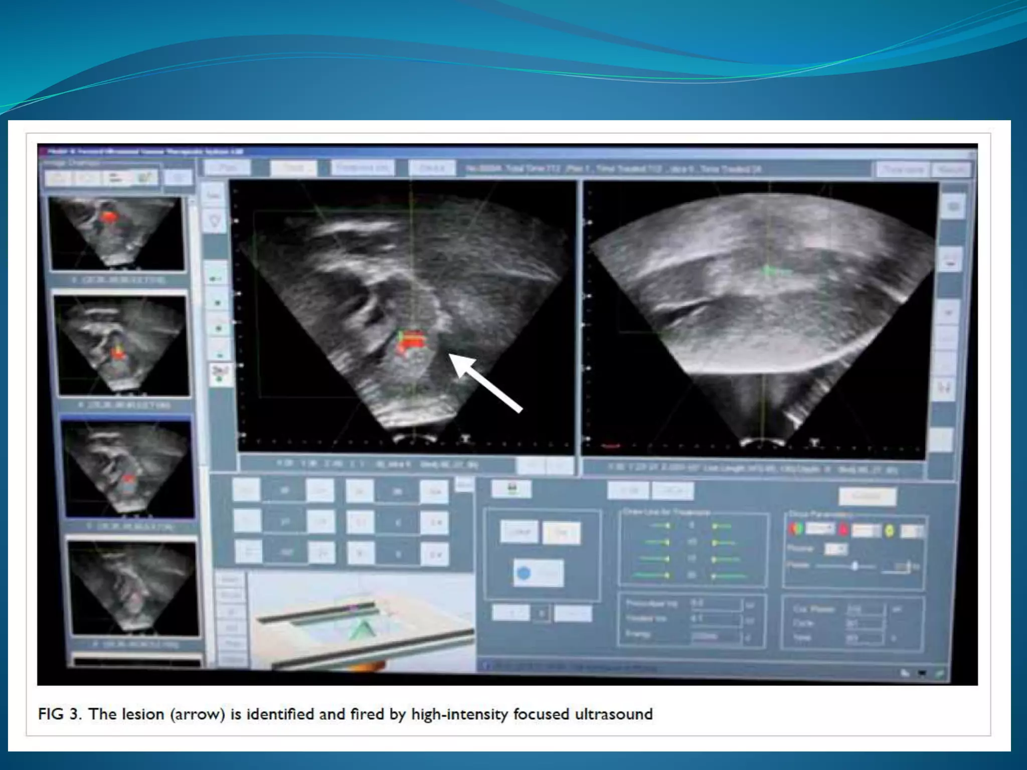 HIFU Technique of Prostate Cancer | PPTX | Cancer | Diseases and Conditions