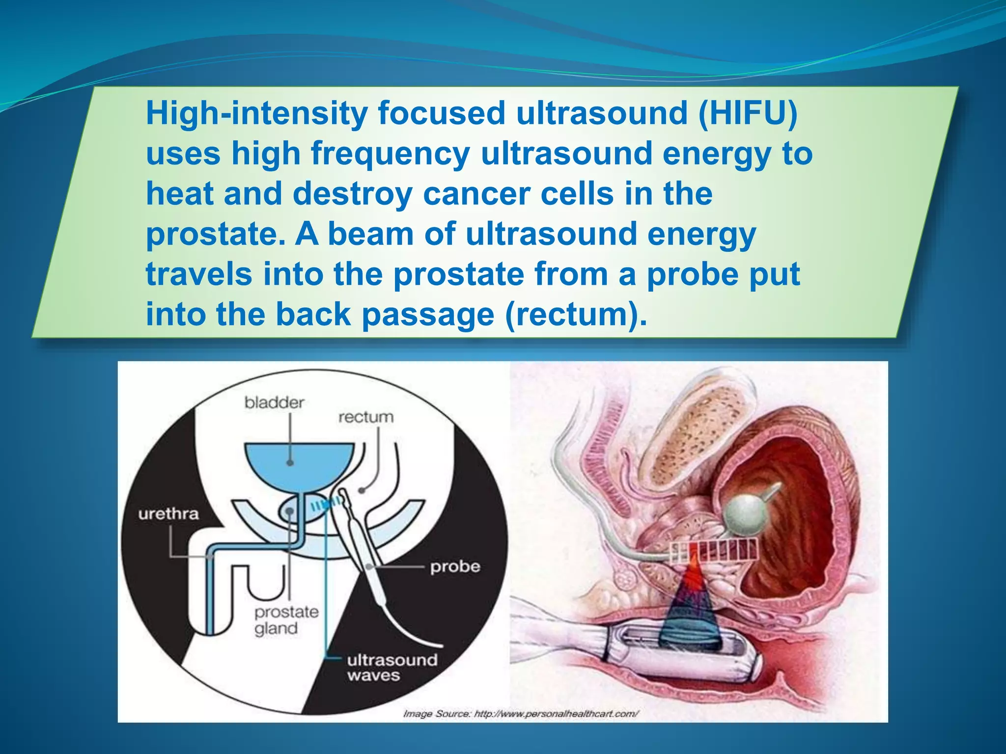 HIFU Technique of Prostate Cancer | PPTX
