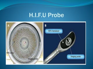 HIFU Technique of Prostate Cancer | PPTX