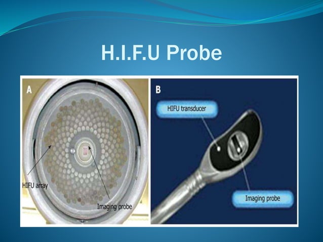 HIFU Technique of Prostate Cancer | PPTX | Cancer | Diseases and Conditions