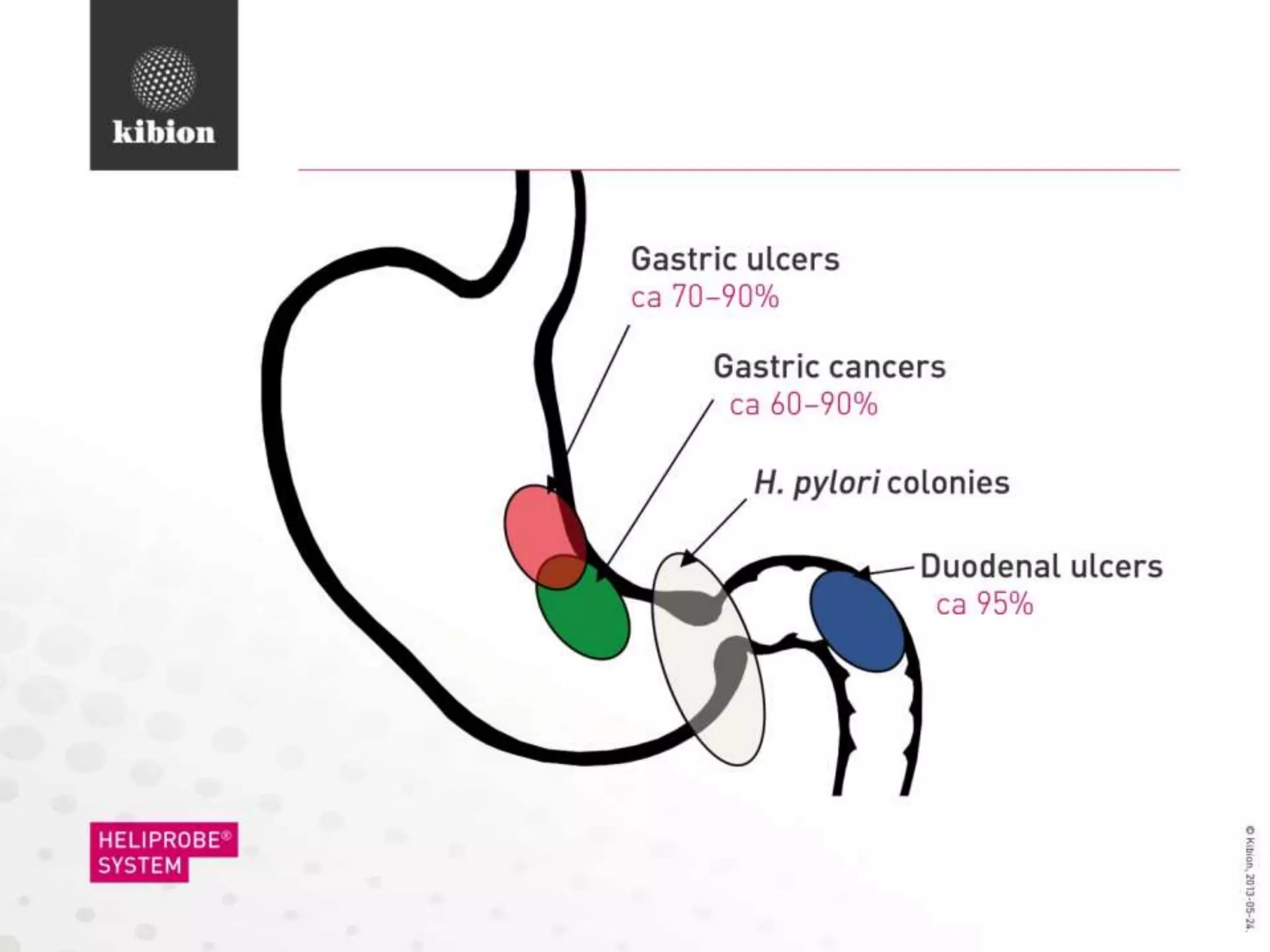 Helicobacter pylori and Peptic Ulcer disease | PPTX