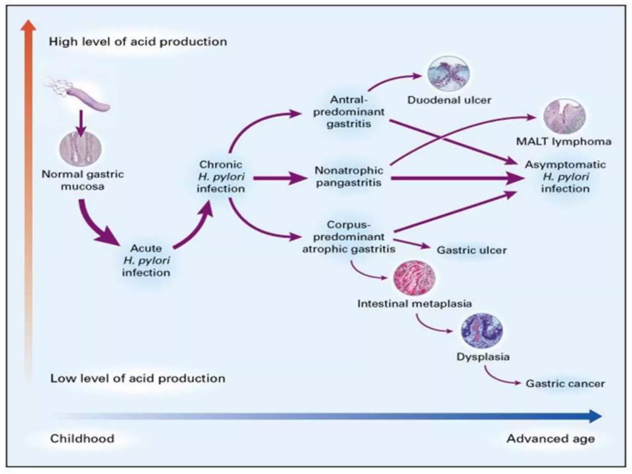 Helicobacter pylori and Peptic Ulcer disease | PPTX
