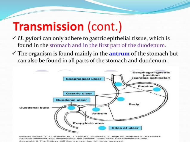 Helicobacter pylori and Peptic Ulcer disease | PPTX