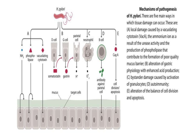 Helicobacter pylori and Peptic Ulcer disease | PPTX