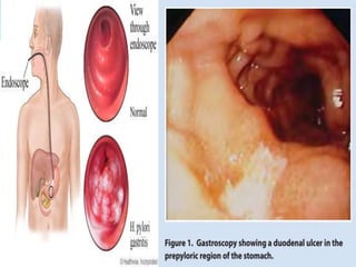Helicobacter pylori and Peptic Ulcer disease | PPTX