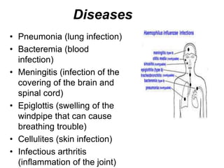 H. influenza | PPT