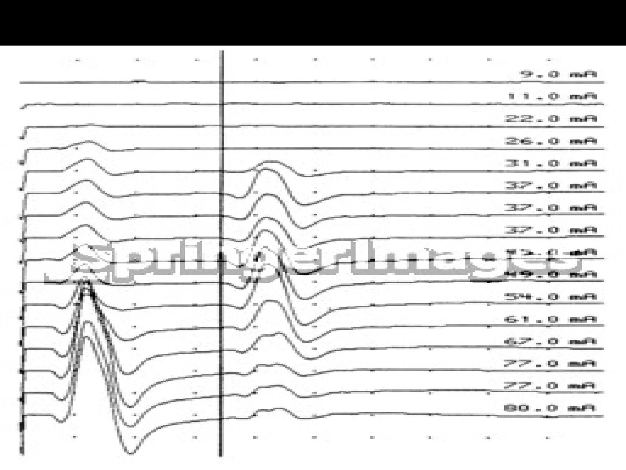 H reflex (Hoffmann's Reflex) | PPT