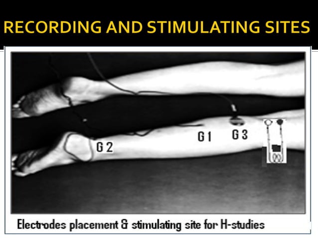 H reflex (Hoffmann's Reflex) | PPT