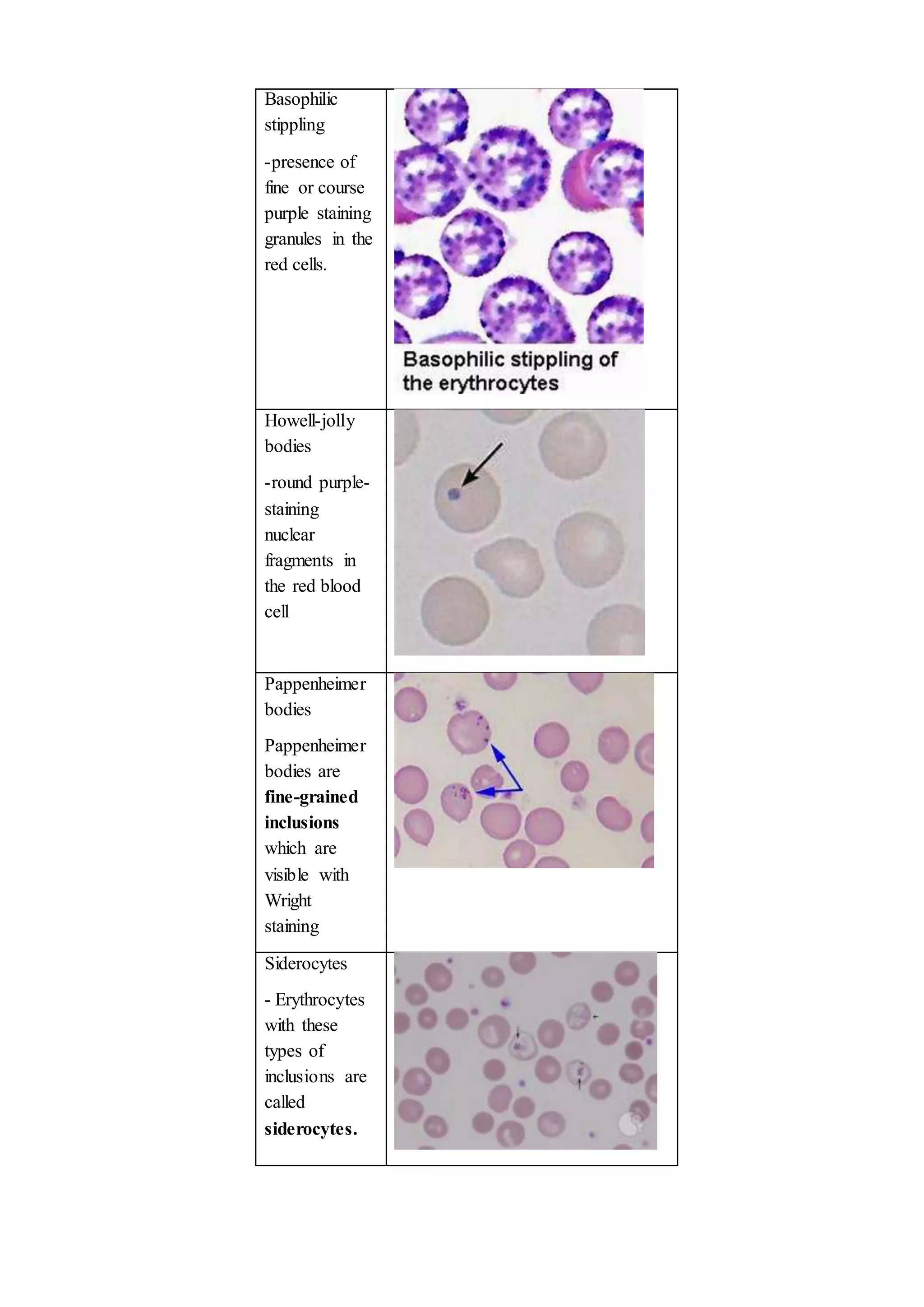 Pappenheimer Bodies Vs Basophilic Stippling