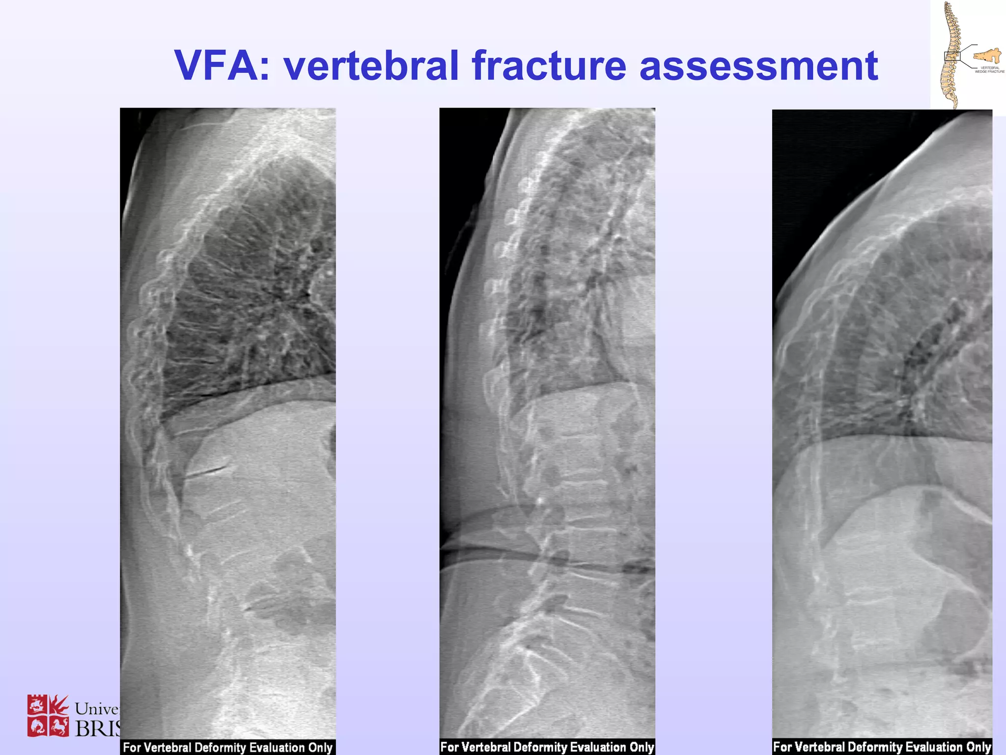 Osteoporosis 2016 | Fracture Risk Assessment: Vertebral fractures: Dr ...
