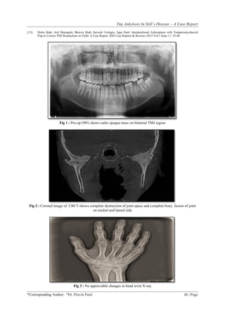 Tmj Ankylosis In Still’s Disease – A Case Report | PDF