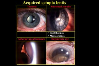 26 ectopia lentis | PPT