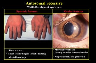 26 ectopia lentis | PPT