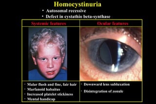 26 ectopia lentis | PPT | Eye and Vision Conditions | Diseases and ...