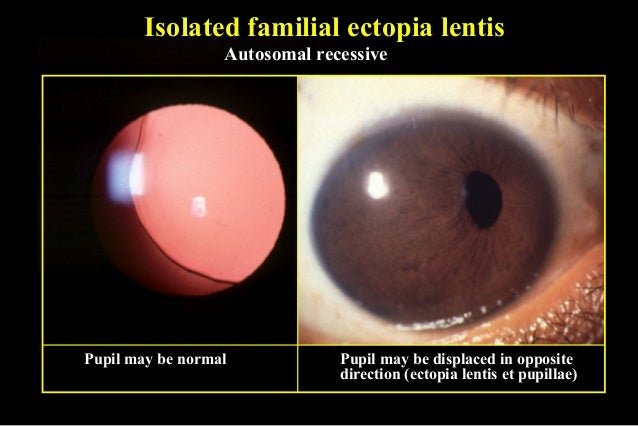 26 ectopia lentis