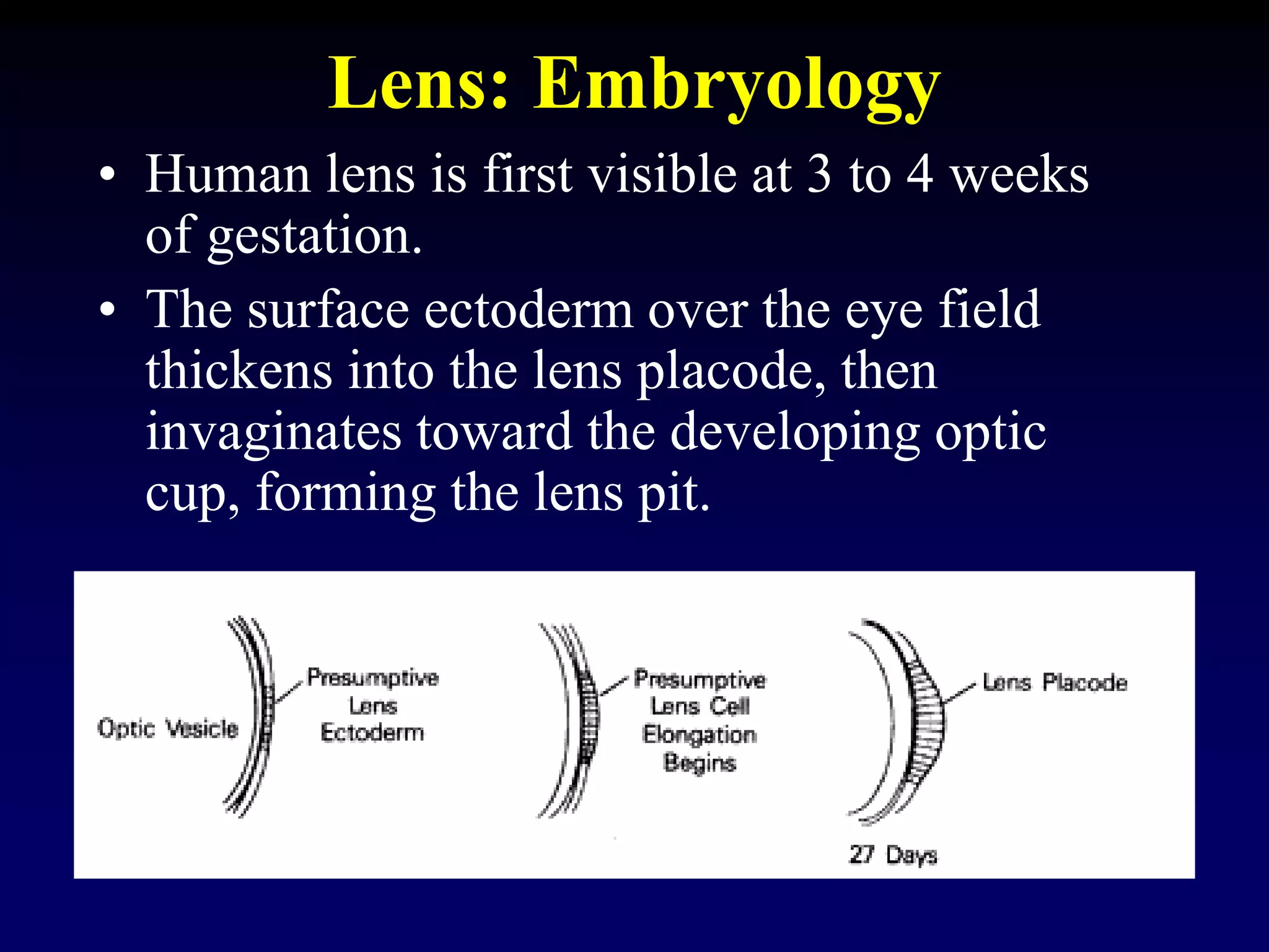 H2 - Congenital & Developmental Cataract.ppt