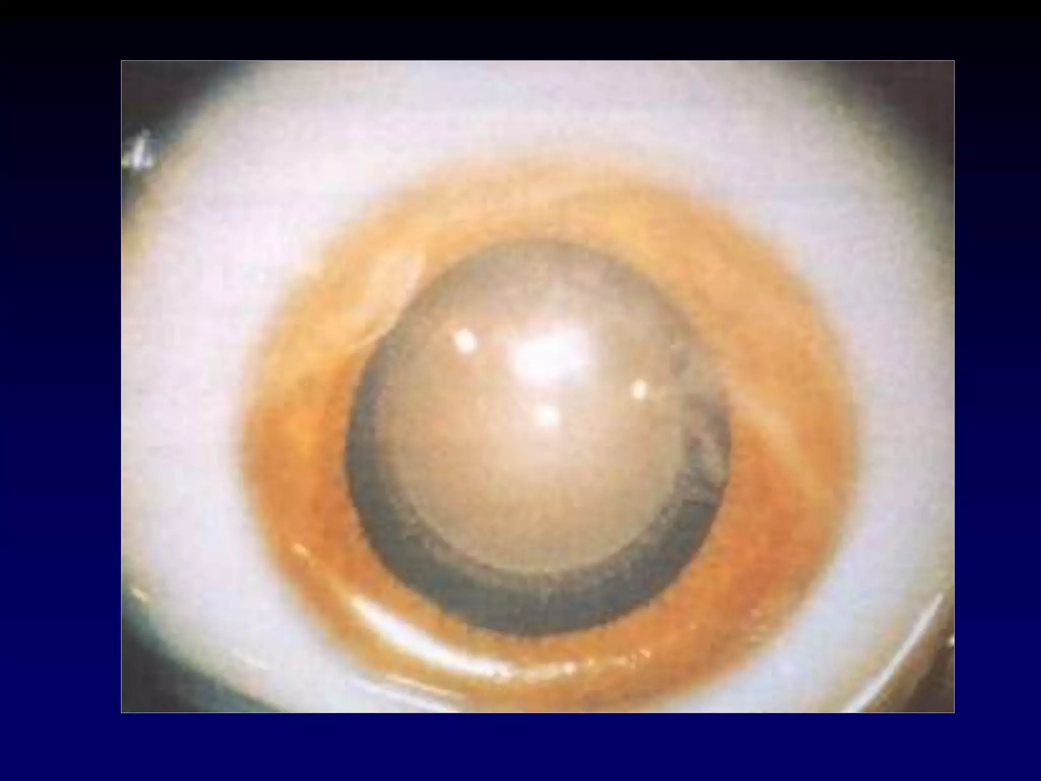 H2 - Congenital & Developmental Cataract.ppt