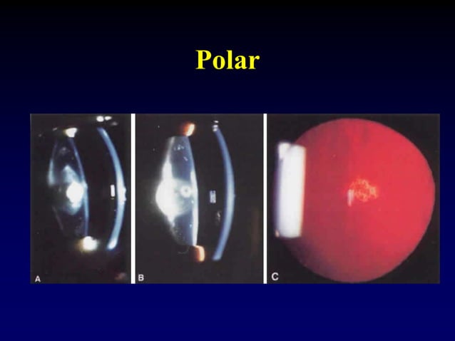 H2 - Congenital & Developmental Cataract.ppt