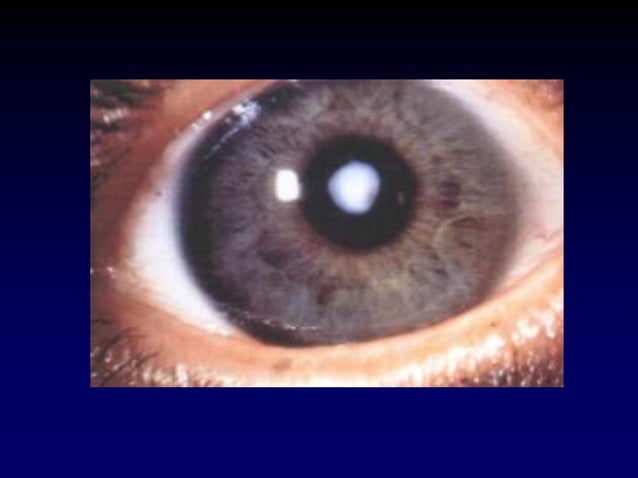 H2 - Congenital & Developmental Cataract.ppt