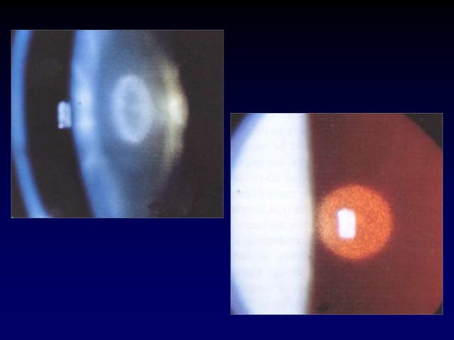 H2 - Congenital & Developmental Cataract.ppt