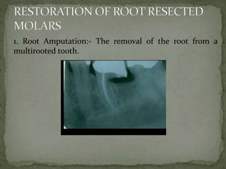 Periodontally Compromised Dentiition | PPTX