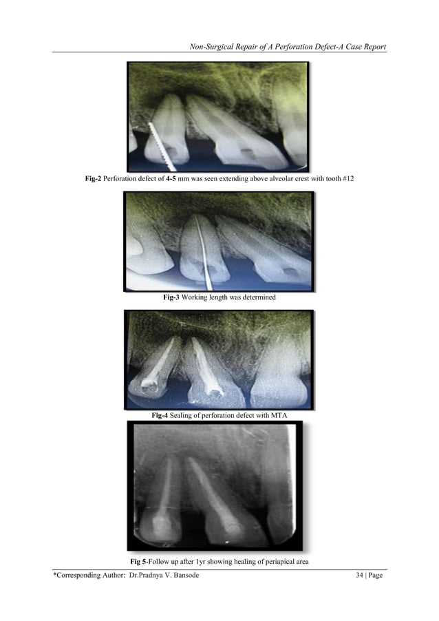 Non-Surgical Repair of A Perforation Defect-A Case Report | PDF