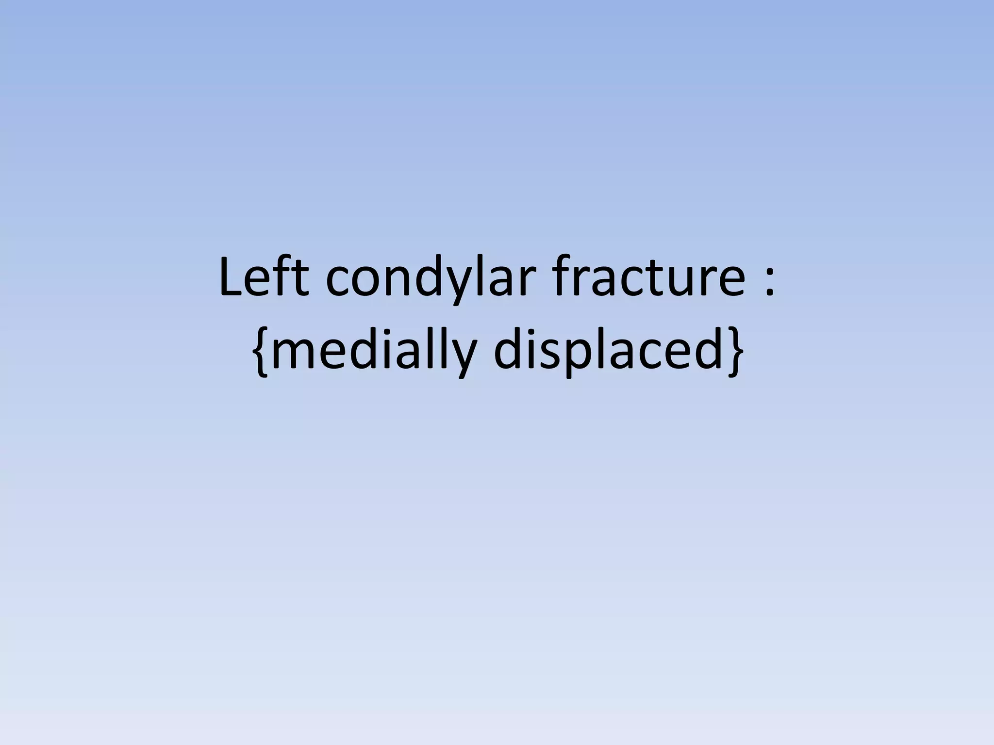 condylar_fracture_Anas_shoaib.ppt