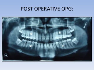 condylar_fracture_Anas_shoaib.ppt