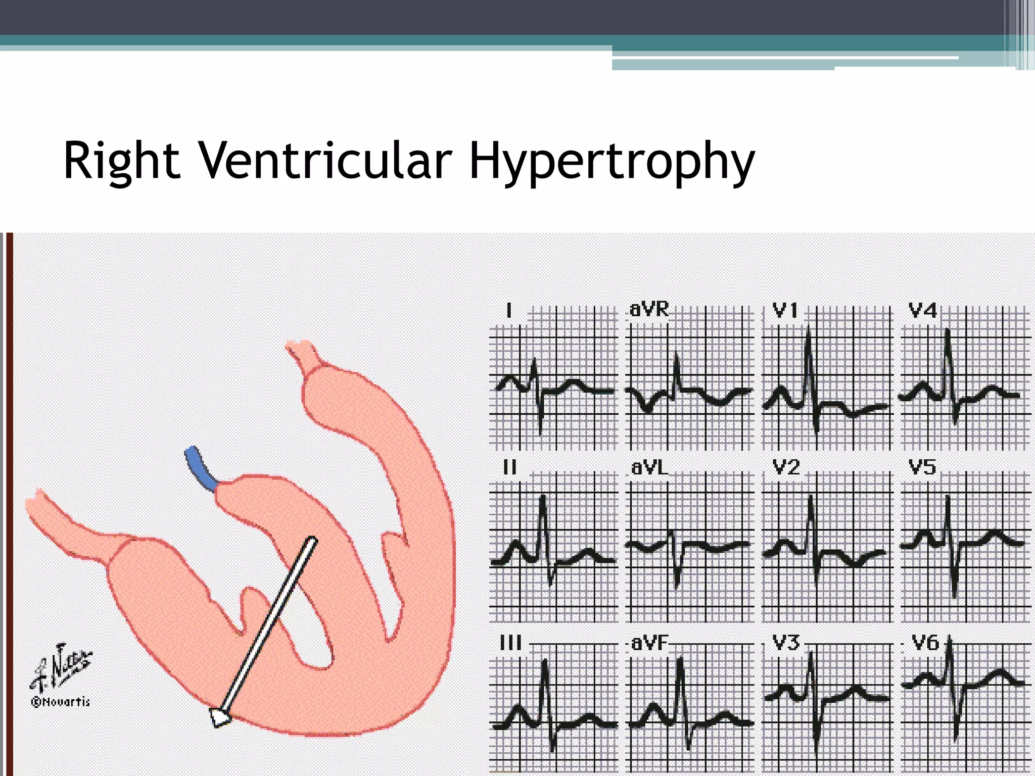 Pediatric ECG final.pptx