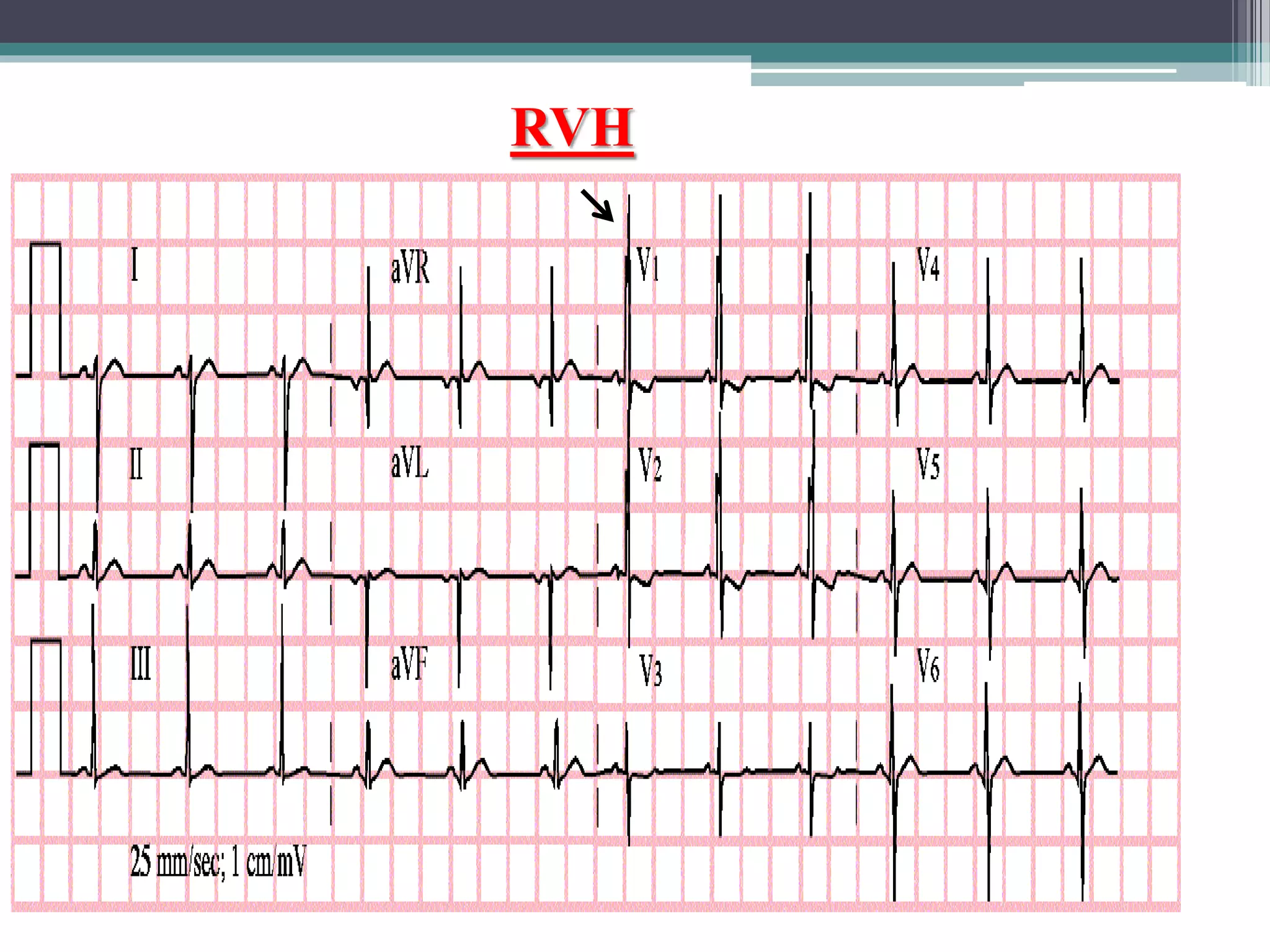 Pediatric ECG final.pptx