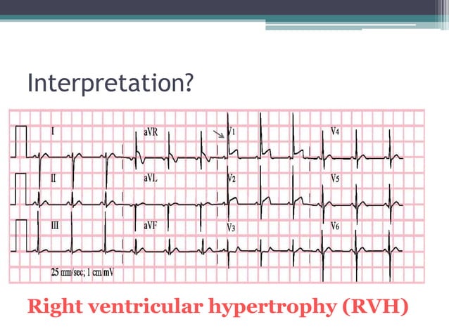 Pediatric ECG final.pptx