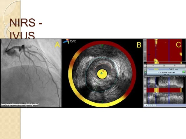 Radiation Diagnosis of Disease of Heart and Blood Vessels | PPT