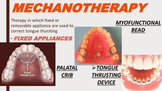 Habit breaking appliances | PPTX