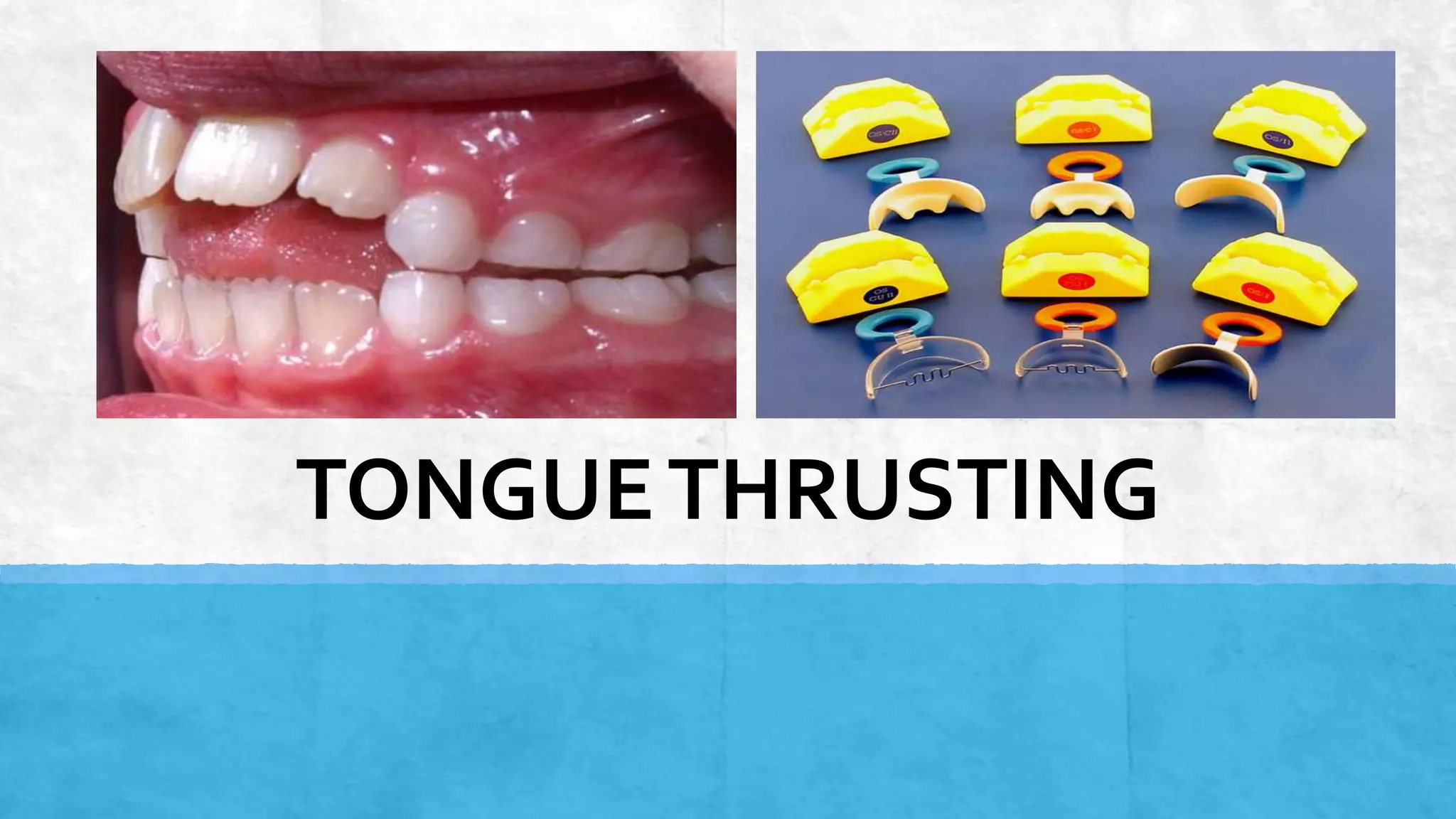 Oral Habits in Children. Part II: Tongue thrusting,Mouth Breathing,Frenum thrusting,Cheek biting ...