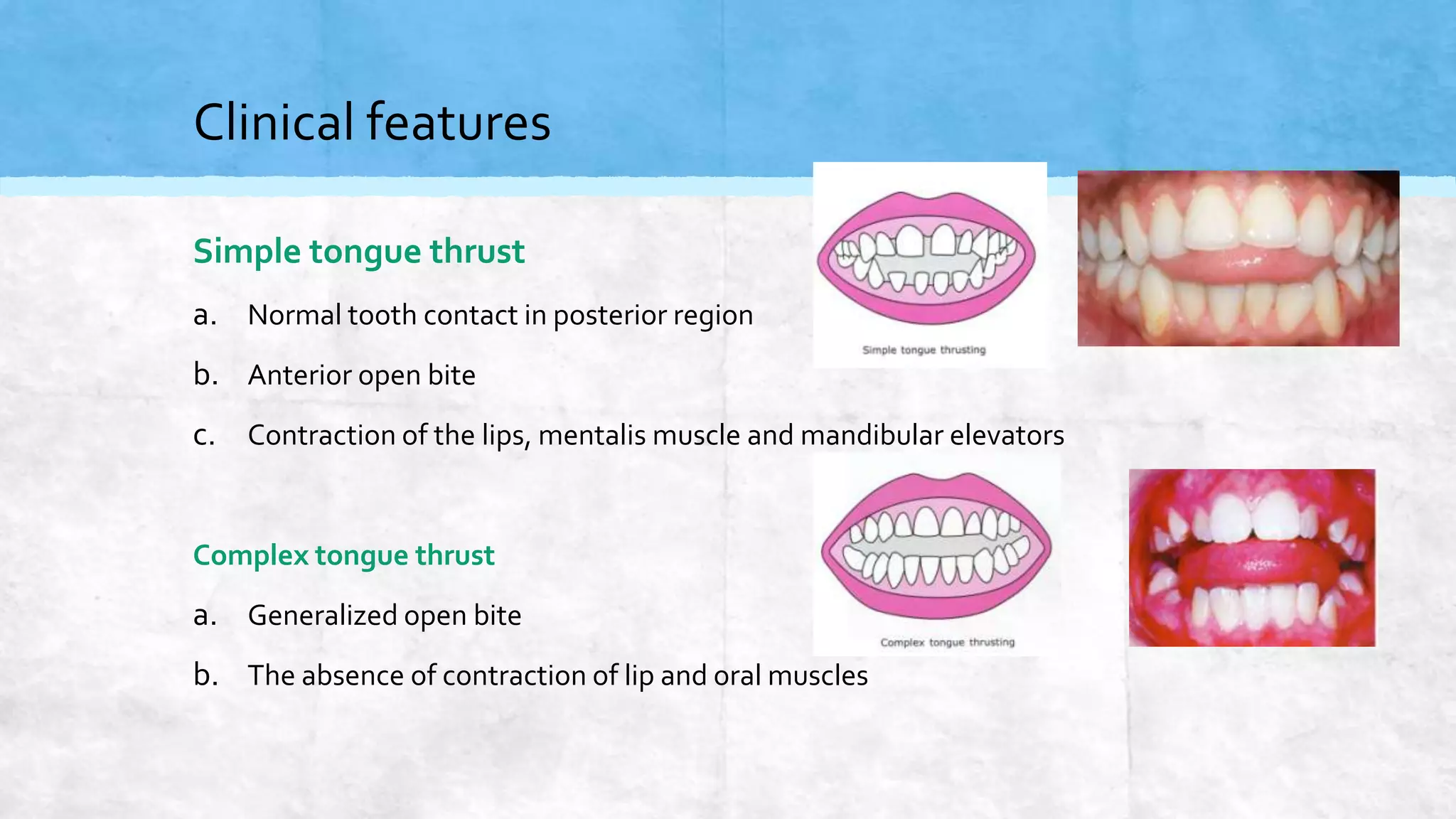 Oral Habits in Children. Part II: Tongue thrusting,Mouth Breathing ...
