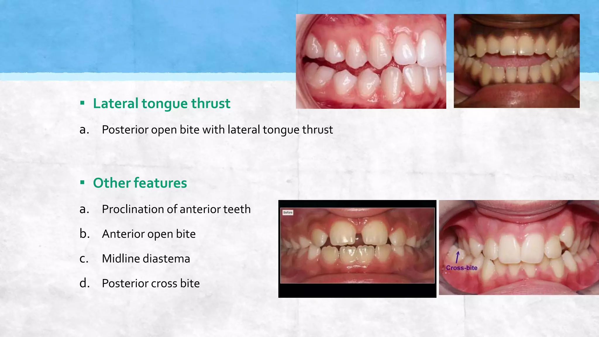 Oral Habits in Children. Part II: Tongue thrusting,Mouth Breathing ...