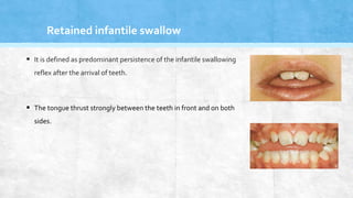 Oral Habits in Children. Part II: Tongue thrusting,Mouth Breathing ...