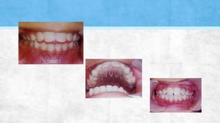 Oral Habits in Children. Part II: Tongue thrusting,Mouth Breathing,Frenum thrusting,Cheek biting ...